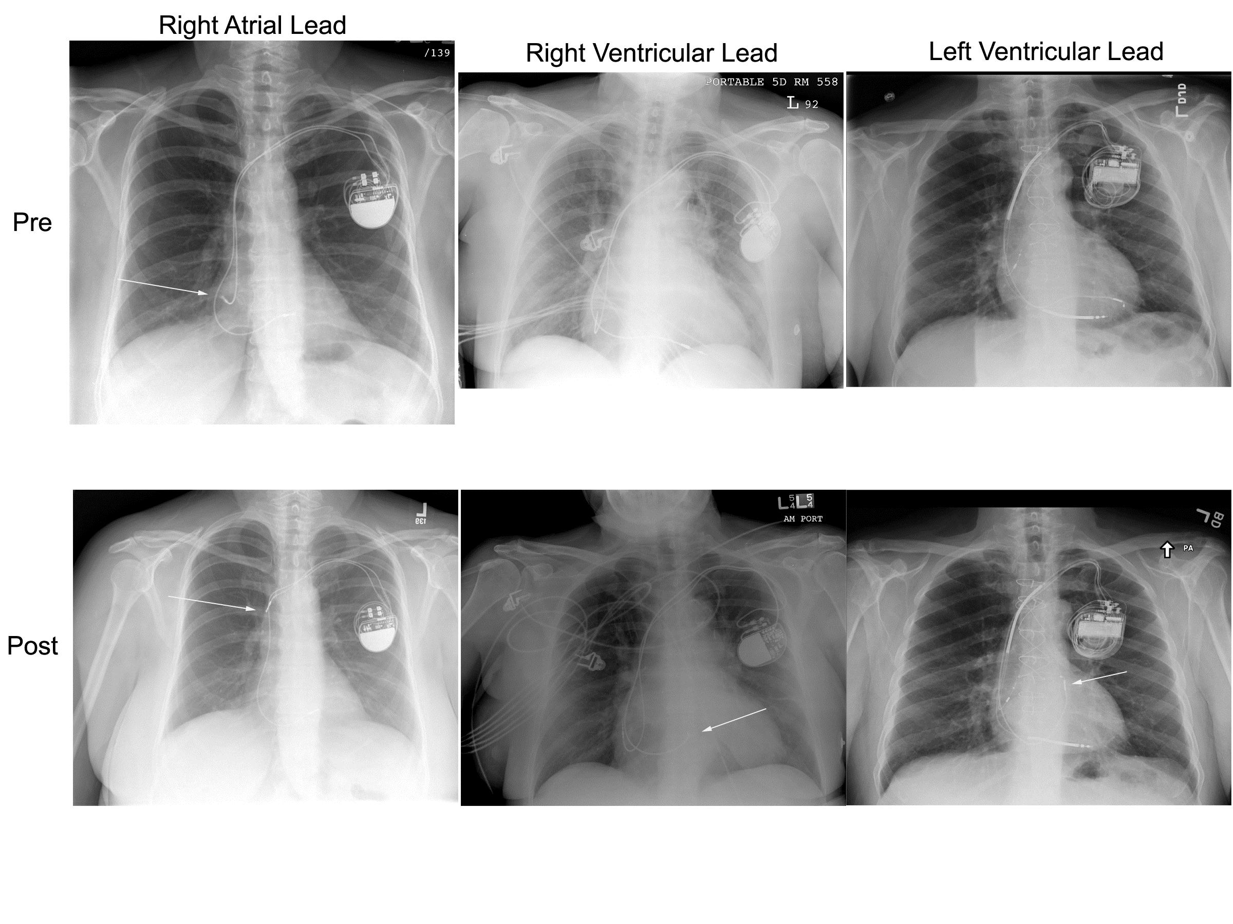 Pacemaker Implantation in the Extreme Elderly – Heart Rhythm Center