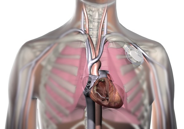 How are Pacemaker Leads Implanted? – Heart Rhythm Center