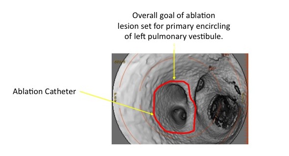 Intracardiac Echo (ICE) Guided Atrial Fibrillation Ablation – Heart ...