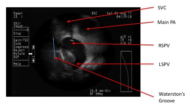 Intracardiac Echo (ICE) Guided Atrial Fibrillation Ablation – Heart ...