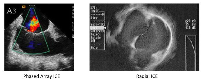 Intracardiac Echo (ICE) for Heart Rhythm Procedures – Heart Rhythm Center