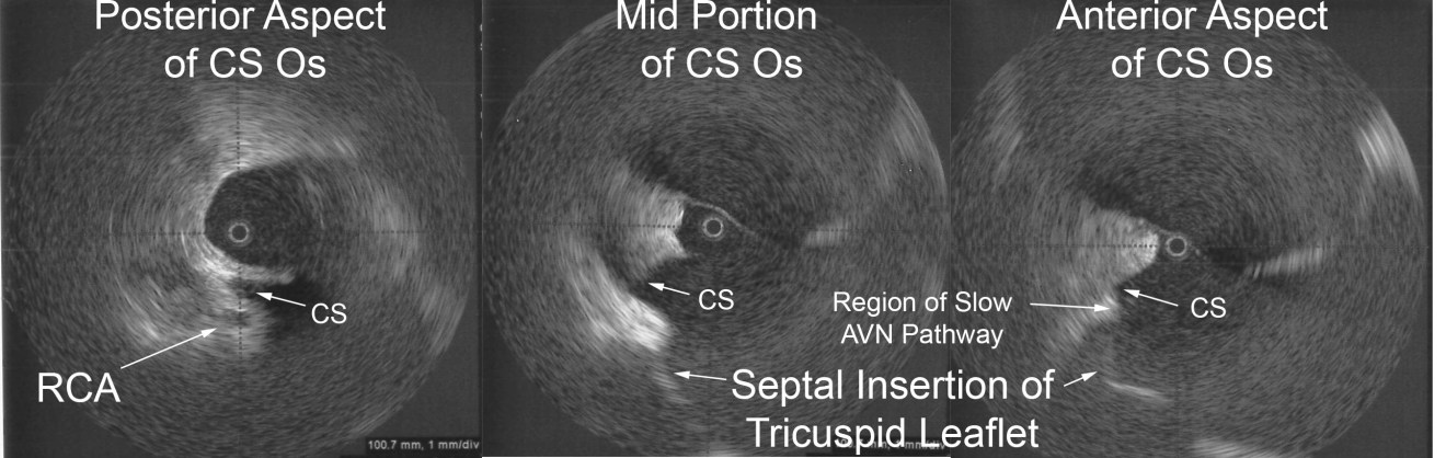 Intracardiac Echo (ICE) – Heart Rhythm Center